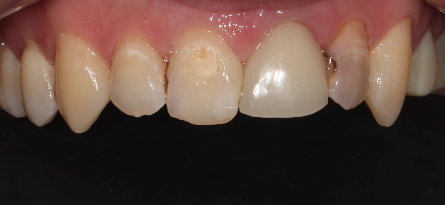 Dantų laminatės - VIN Vilniaus Implantologijos Namai